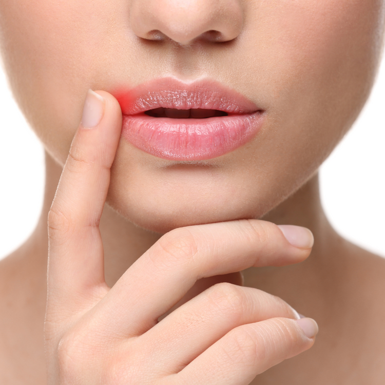 How Common Are Cold Sores? – NextLeap Skincare